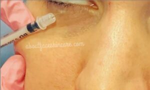 Botox Injections for Jelly Rolls | About Face Aesthetics