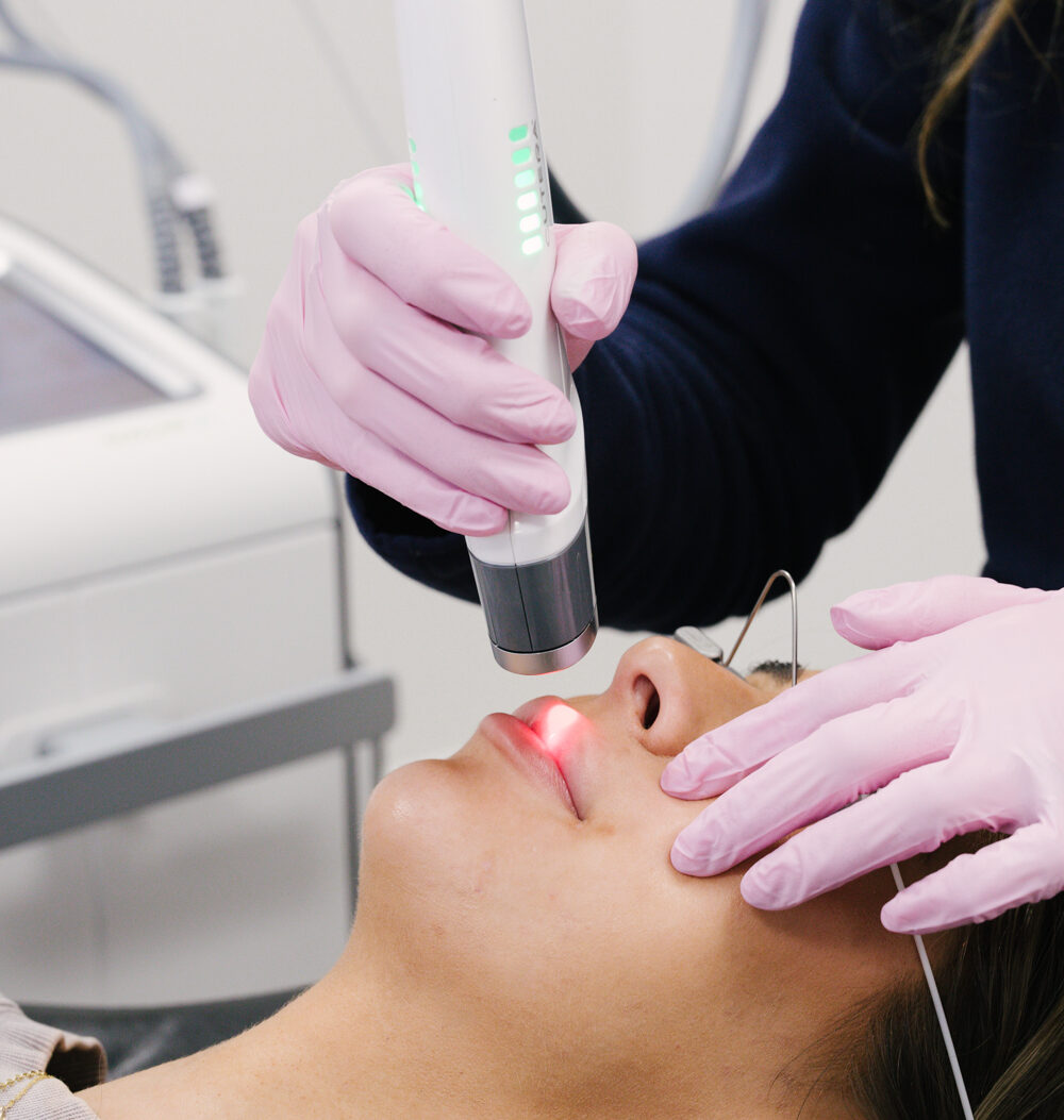 Lip Laser Plumping in Philadelphia | Needle-free Volume Enhancement ...